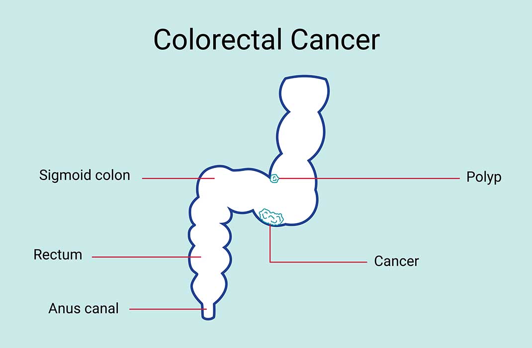 Colorectal Cancer in Young Adults | Mass General Brigham